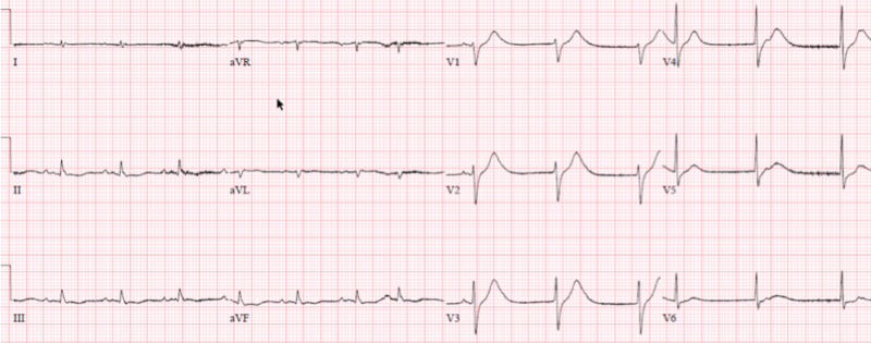 Is 15 lead ECG better than 12? Diagnosing Posterior MI and RVMI | ECG ...