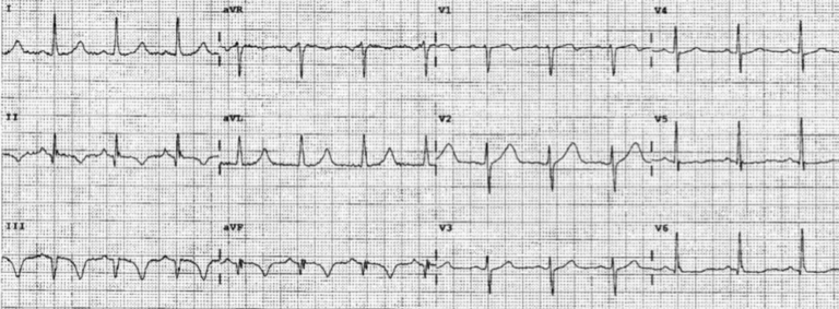 Is 15 lead ECG better than 12? Diagnosing Posterior MI and RVMI | ECG ...