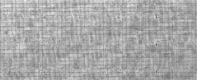 Is 15 lead ECG better than 12? Diagnosing Posterior MI and RVMI | ECG ...
