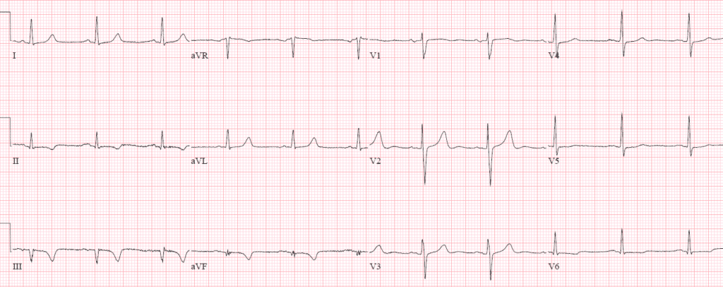 Is 15 lead ECG better than 12? Diagnosing Posterior MI and RVMI | ECG ...