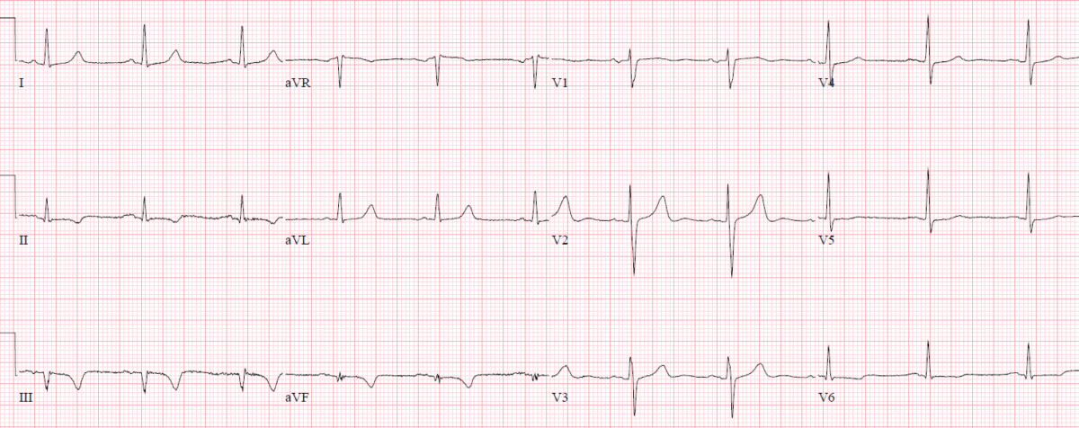 Is 15 lead ECG better than 12? Diagnosing Posterior MI and RVMI | ECG ...