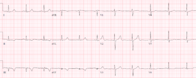 Is 15 lead ECG better than 12? Diagnosing Posterior MI and RVMI | ECG ...