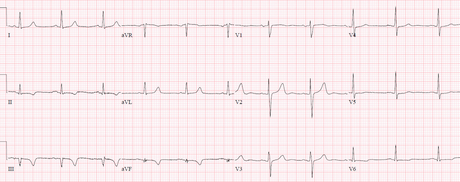 Is 15 lead ECG better than 12? Diagnosing Posterior MI and RVMI | ECG ...