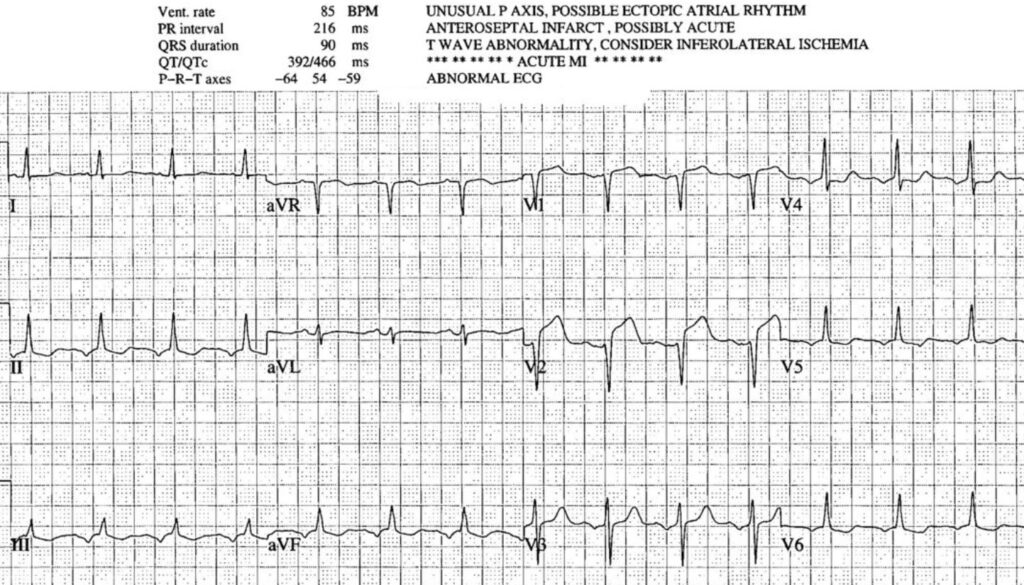 Is 15 lead ECG better than 12? Diagnosing Posterior MI and RVMI | ECG ...