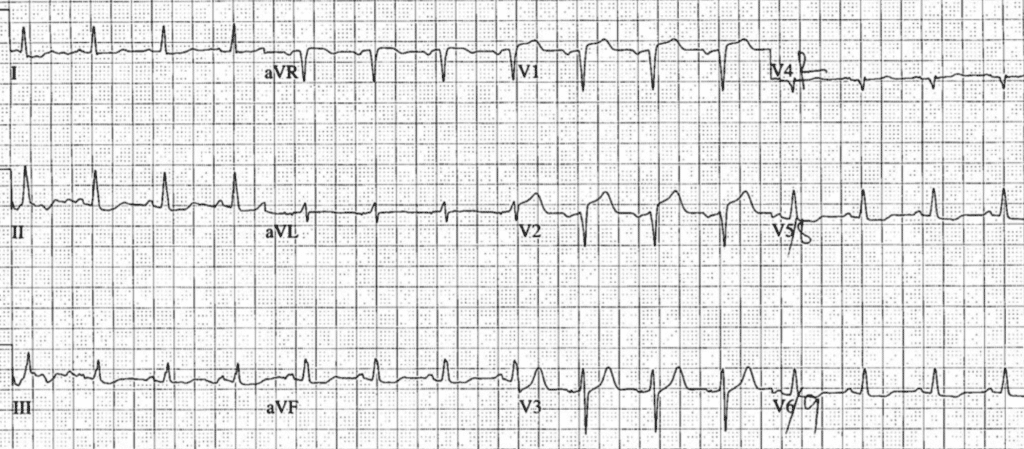 Is 15 lead ECG better than 12? Diagnosing Posterior MI and RVMI | ECG ...