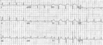 Is 15 lead ECG better than 12? Diagnosing Posterior MI and RVMI | ECG ...