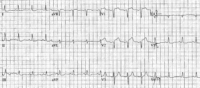 Is 15 lead ECG better than 12? Diagnosing Posterior MI and RVMI | ECG ...