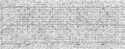 Is 15 lead ECG better than 12? Diagnosing Posterior MI and RVMI | ECG ...