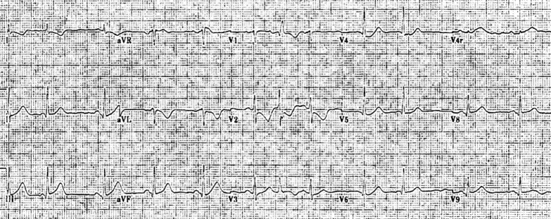 Is 15 lead ECG better than 12? Diagnosing Posterior MI and RVMI | ECG ...