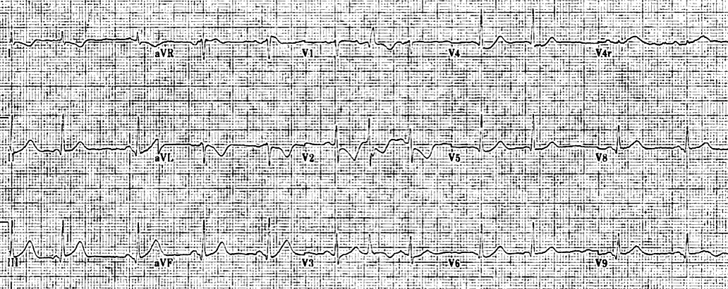 Is 15 lead ECG better than 12? Diagnosing Posterior MI and RVMI | ECG ...