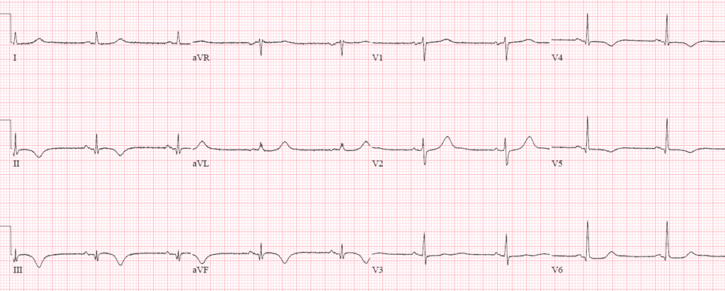 Is 15 lead ECG better than 12? Diagnosing Posterior MI and RVMI | ECG ...
