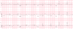 Is 15 lead ECG better than 12? Diagnosing Posterior MI and RVMI | ECG ...