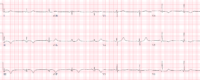 Is 15 lead ECG better than 12? Diagnosing Posterior MI and RVMI | ECG ...