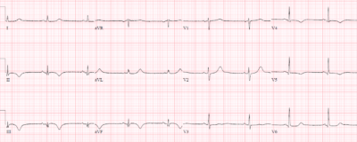 Is 15 lead ECG better than 12? Diagnosing Posterior MI and RVMI | ECG ...