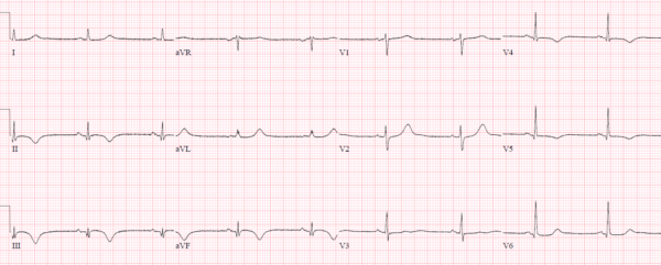 Is 15 lead ECG better than 12? Diagnosing Posterior MI and RVMI | ECG ...