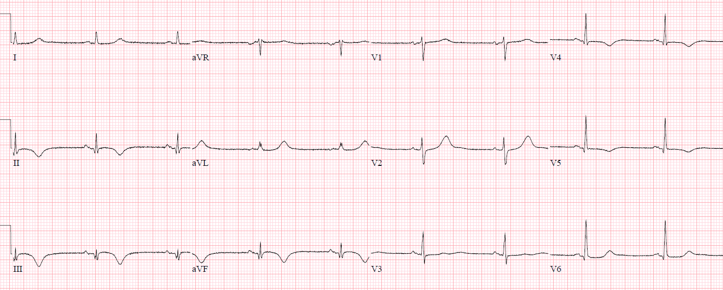 Is 15 lead ECG better than 12? Diagnosing Posterior MI and RVMI | ECG ...