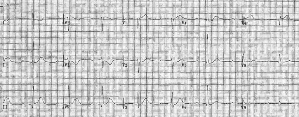 Is 15 lead ECG better than 12? Diagnosing Posterior MI and RVMI | ECG ...
