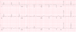 Is 15 lead ECG better than 12? Diagnosing Posterior MI and RVMI | ECG ...