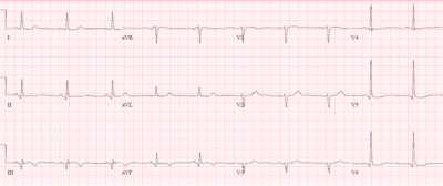 Is 15 lead ECG better than 12? Diagnosing Posterior MI and RVMI | ECG ...
