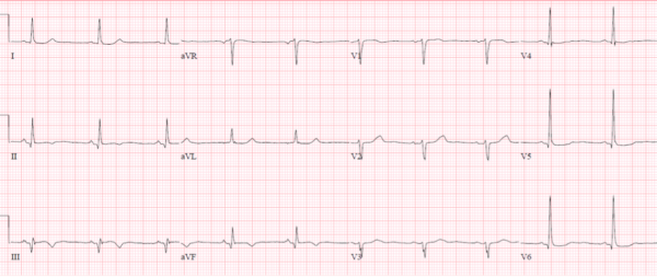 Is 15 lead ECG better than 12? Diagnosing Posterior MI and RVMI | ECG ...