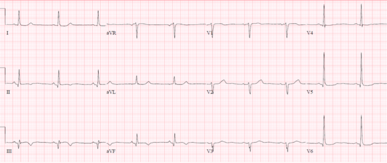 Is 15 lead ECG better than 12? Diagnosing Posterior MI and RVMI | ECG ...