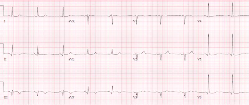 Is 15 lead ECG better than 12? Diagnosing Posterior MI and RVMI | ECG ...