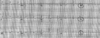 Is 15 lead ECG better than 12? Diagnosing Posterior MI and RVMI | ECG ...
