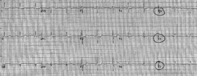Is 15 lead ECG better than 12? Diagnosing Posterior MI and RVMI | ECG ...