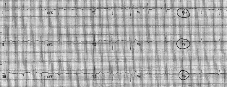 Is 15 lead ECG better than 12? Diagnosing Posterior MI and RVMI | ECG ...