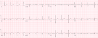Is 15 lead ECG better than 12? Diagnosing Posterior MI and RVMI | ECG ...
