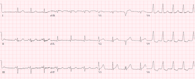 ECG Cases 32 Prehospital ECG pearls, pitfalls | ECG cases | EM Cases