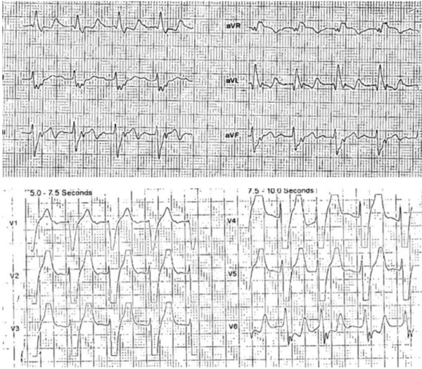 ECG Cases 32 Prehospital ECG pearls, pitfalls | ECG cases | EM Cases