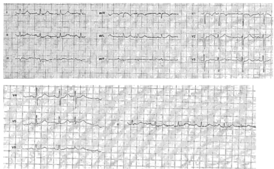 ECG Cases 32 Prehospital ECG pearls, pitfalls | ECG cases | EM Cases