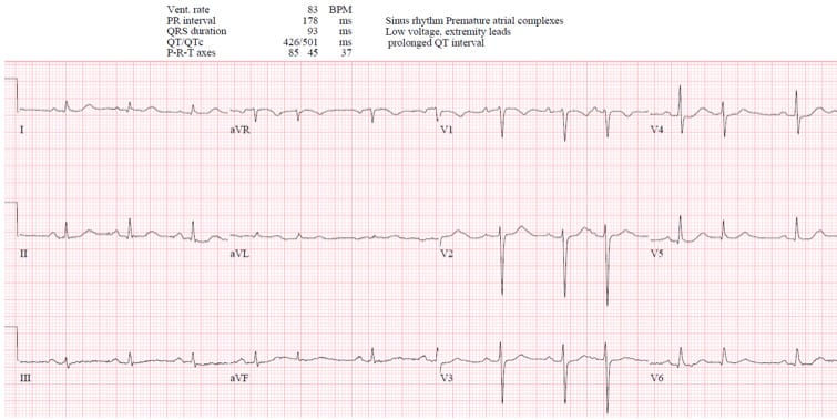 ECG Cases 32 Prehospital ECG pearls, pitfalls | ECG cases | EM Cases