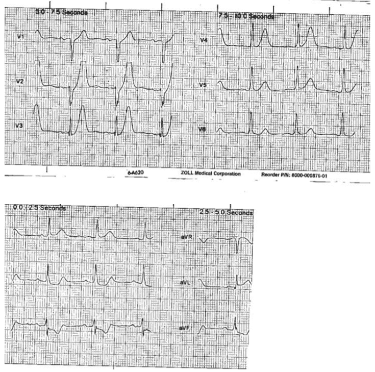 ECG Cases 32 Prehospital ECG pearls, pitfalls | ECG cases | EM Cases