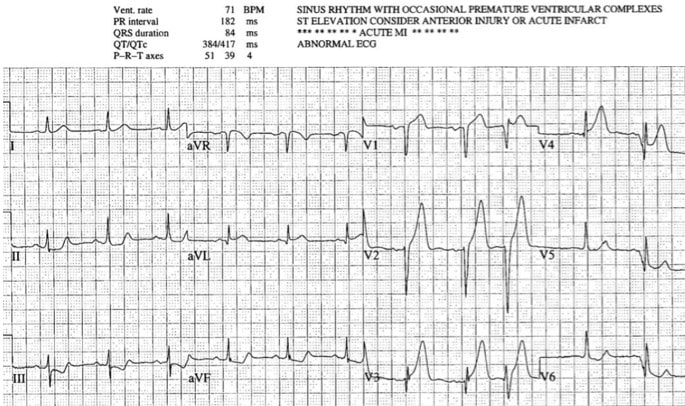 ECG Cases 32 Prehospital ECG pearls, pitfalls | ECG cases | EM Cases