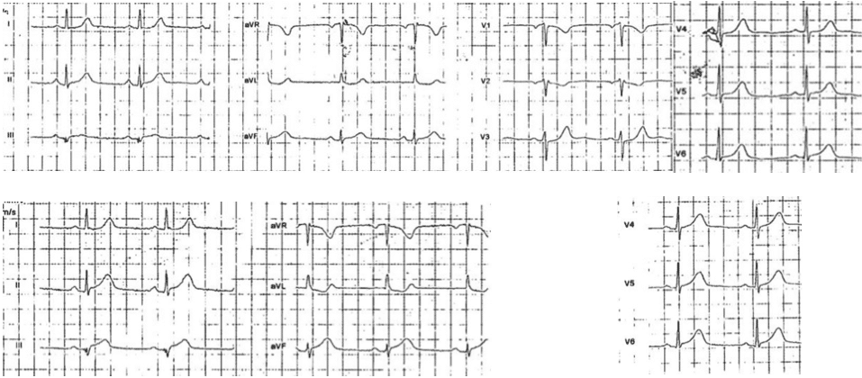 ECG Cases 32 Prehospital ECG pearls, pitfalls | ECG cases | EM Cases