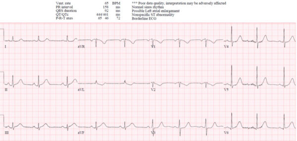 ECG Cases 32 Prehospital ECG pearls, pitfalls | ECG cases | EM Cases
