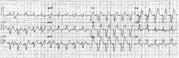ECG Cases 32 Prehospital ECG pearls, pitfalls | ECG cases | EM Cases