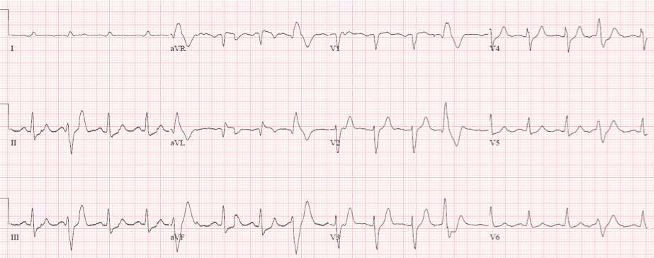 ECG Cases 32 Prehospital ECG pearls, pitfalls | ECG cases | EM Cases