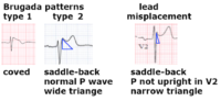 Sudden cardiac death - Brugada syndrome | ECG Cases | EM Cases