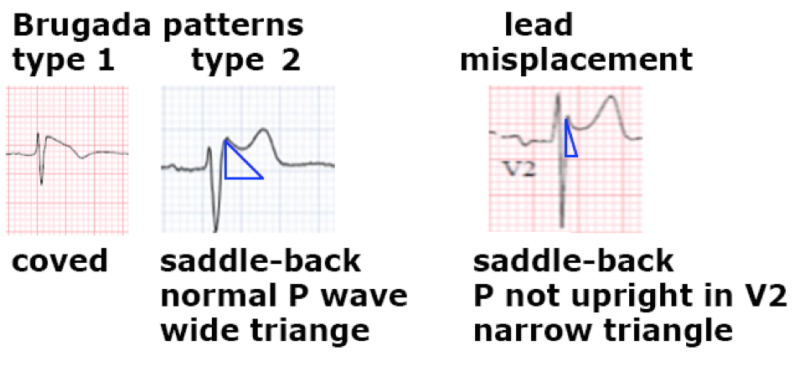 Sudden cardiac death - Brugada syndrome | ECG Cases | EM Cases