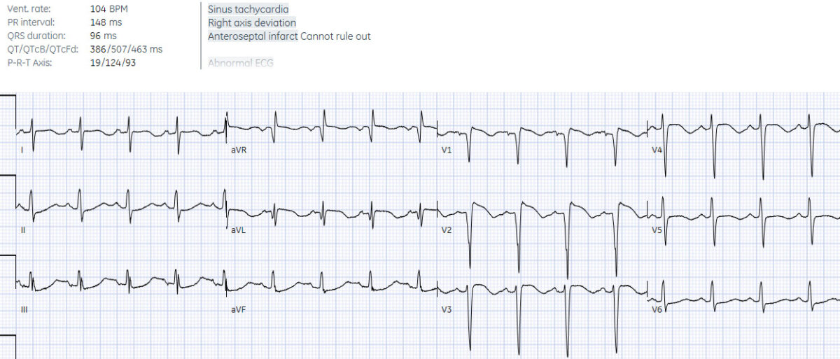 Sudden cardiac death - Brugada syndrome | ECG Cases | EM Cases