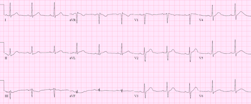Sudden cardiac death - Brugada syndrome | ECG Cases | EM Cases