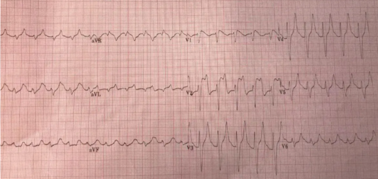 Sudden cardiac death - Brugada syndrome | ECG Cases | EM Cases
