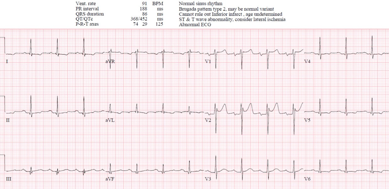 Sudden cardiac death - Brugada syndrome | ECG Cases | EM Cases