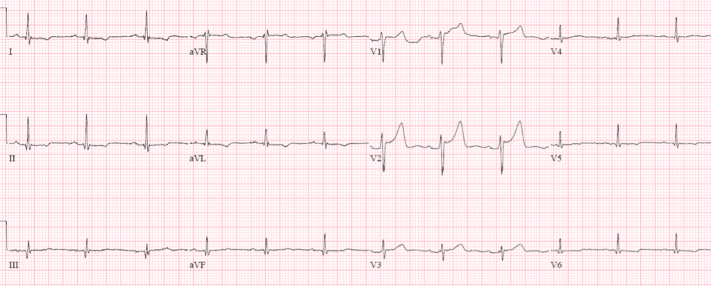 Sudden cardiac death - Brugada syndrome | ECG Cases | EM Cases