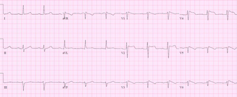 Sudden cardiac death - Brugada syndrome | ECG Cases | EM Cases