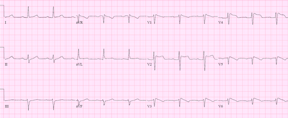 Sudden cardiac death - Brugada syndrome | ECG Cases | EM Cases