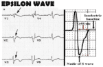 Syncope Simplified | Emergency Medicine Cases